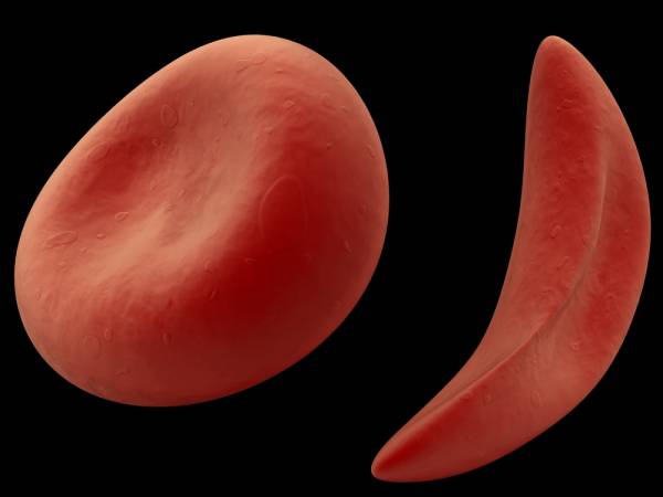 Understanding Sickle Cell Trait and Precautions For Training Athletes ...